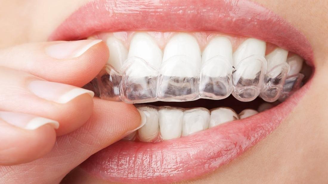 The Invisalign Process At Our Glenmont Office | BTF Dental